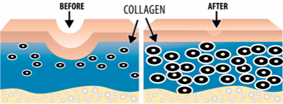 For Acne Scars - Saundra Skin and Body