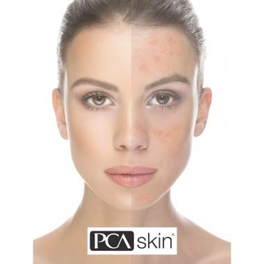 Clinical PCA Skin Peels - Saundra Skin and Body