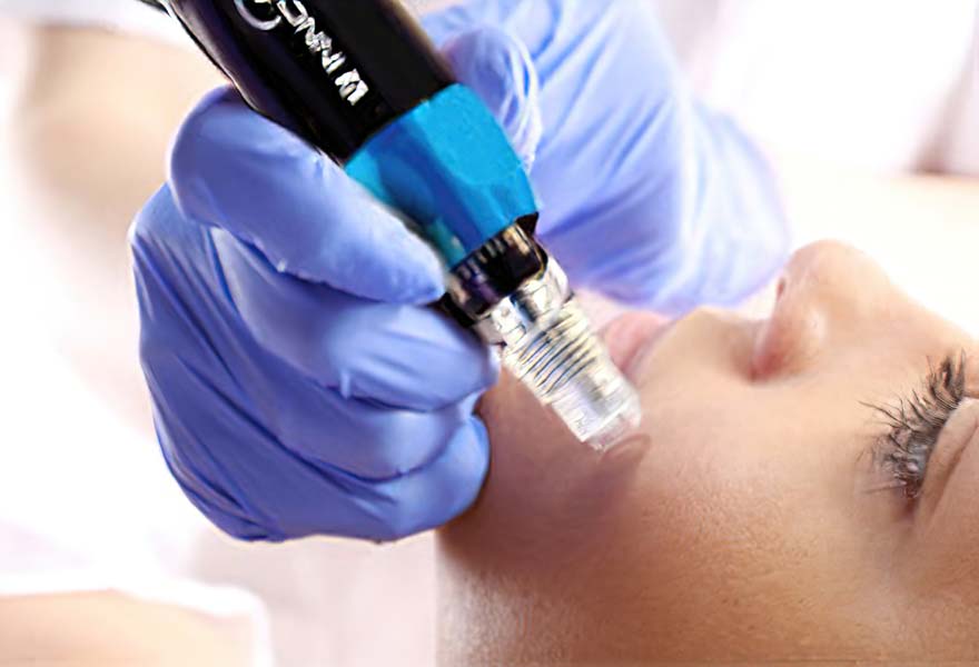 Medical Microneedling - Saundra Skin and Body
